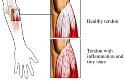 UMPP | Tendinite du coude