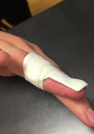 UMPP | Mallet Finger ou doigt en maillet
