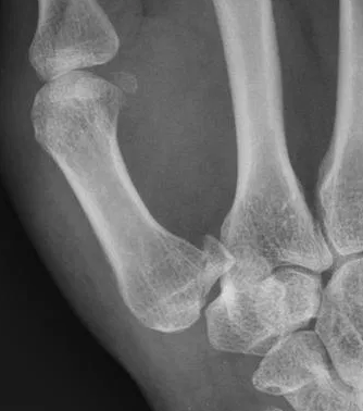 UMPP | Fracture base du pouce